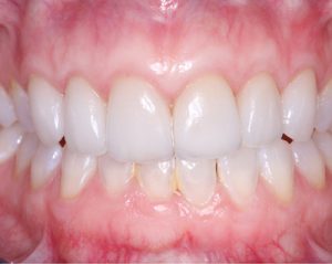 Esthetic-Root-coverage-AFTER-1 | Periodontal and Dental Implant Specialists